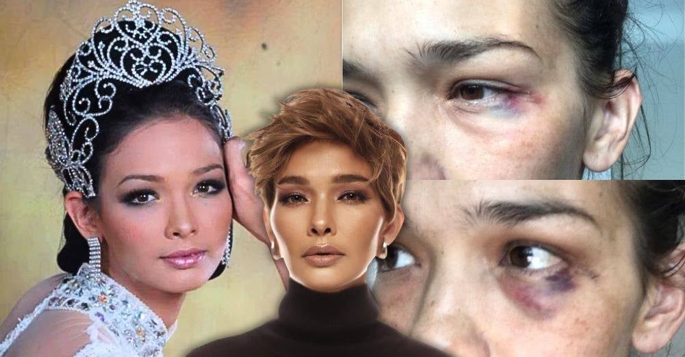 'Saya tidak mahu lakukan ini, tetapi terpaksa.' Foto mata lebam undang ...