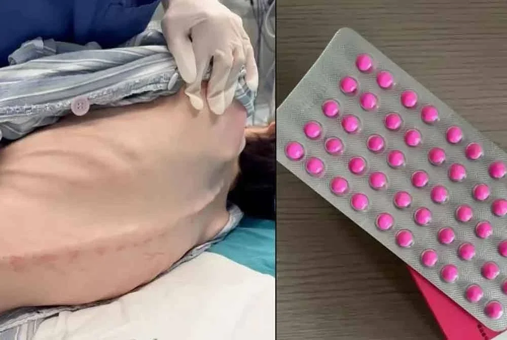 Telan 200 pil kurus setiap hari: Wanita alami kurus melampau, berat ...